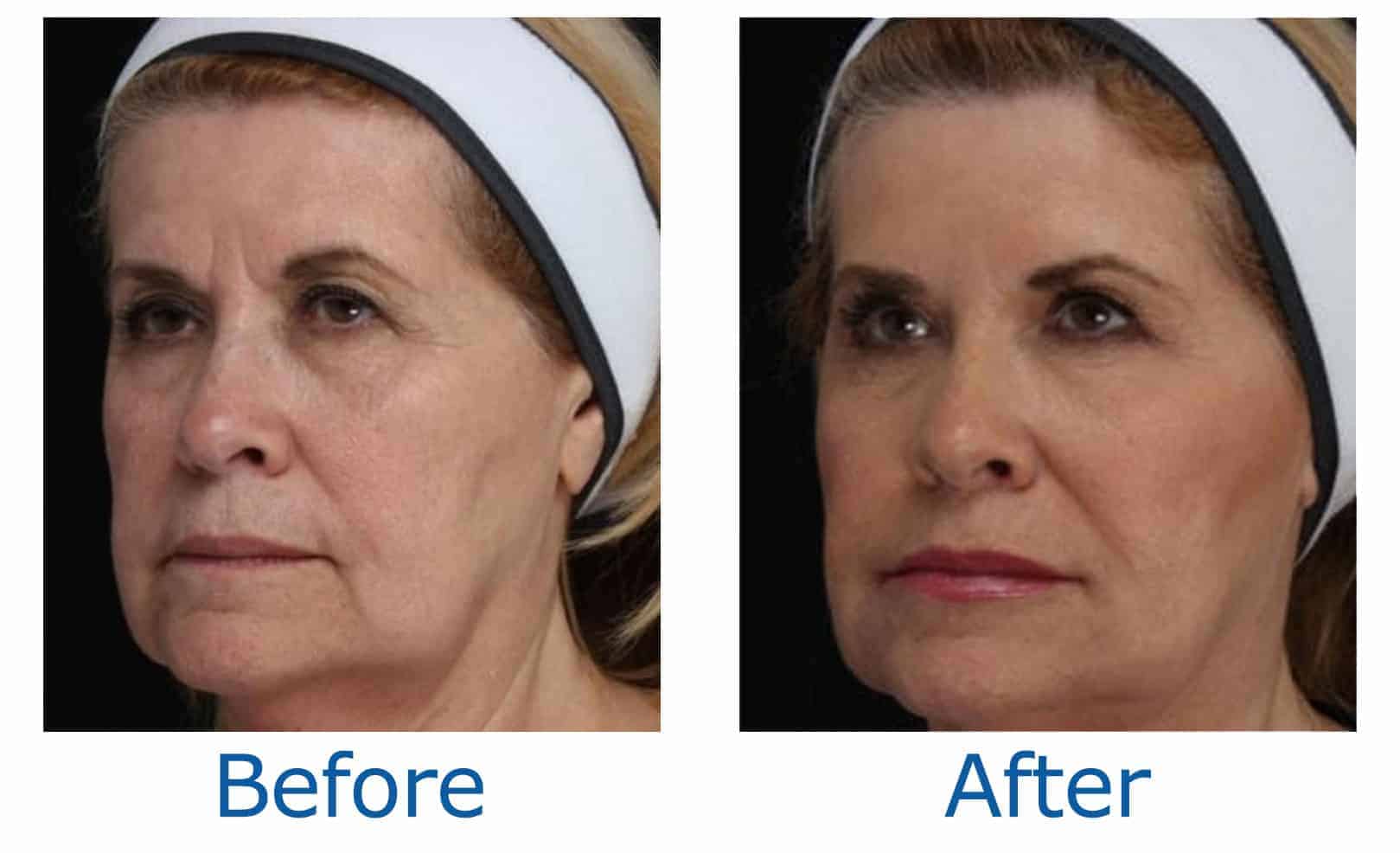 5 Reasons You Will Love Ultherapy | Riverchase Dermatology