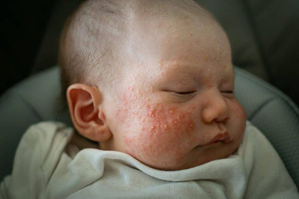 Baby Acne: What Parents Need To Know - Riverchase Dermatology