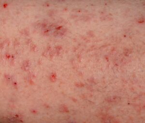 The Scabies Rash and Other Scabies Symptoms to Watch For - Riverchase ...