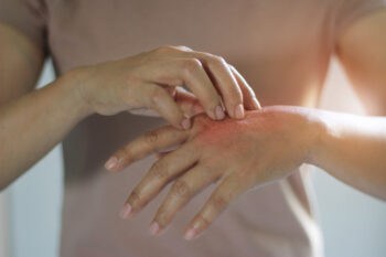 Treating Stress Related-Eczema on Hands | Riverchase Derm