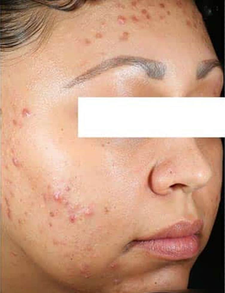Accure Laser Acne Treatment | Riverchase Dermatology