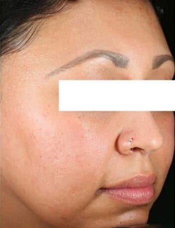 Accure Laser Acne Treatment | Riverchase Dermatology