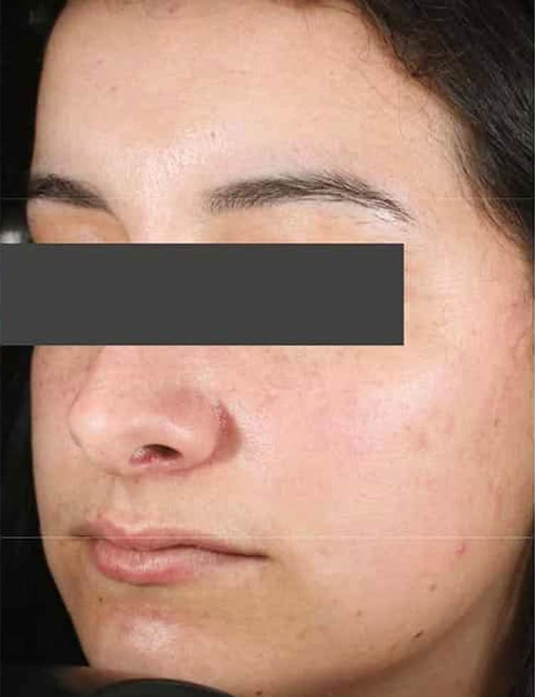 Accure Laser Acne Treatment | Riverchase Dermatology