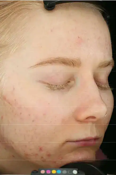 Accure Laser Acne Treatment | Riverchase Dermatology