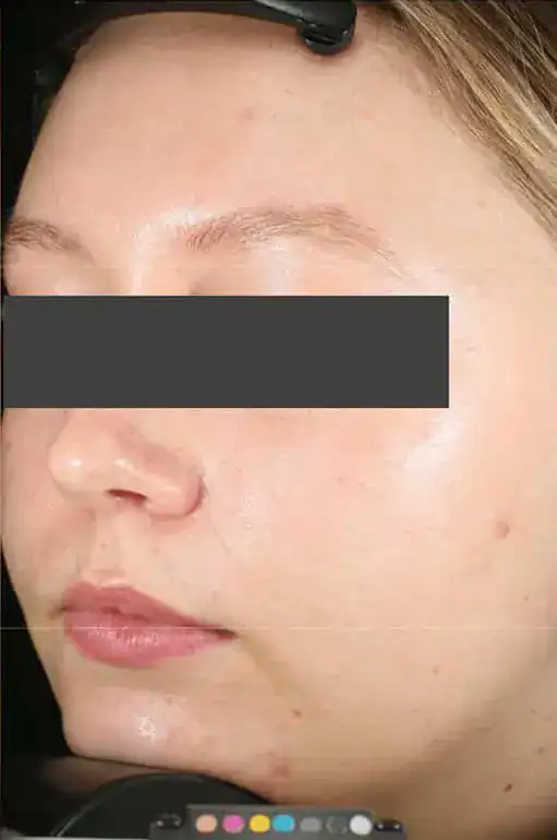 Accure Laser Acne Treatment | Riverchase Dermatology