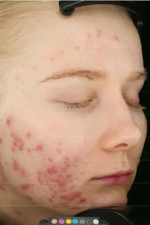 Accure Laser Acne Treatment | Riverchase Dermatology