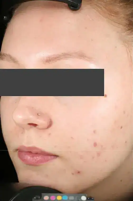 Accure Laser Acne Treatment | Riverchase Dermatology